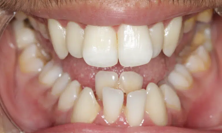 Treating Narrow Jaws | Smiles and Faces Orthodontics