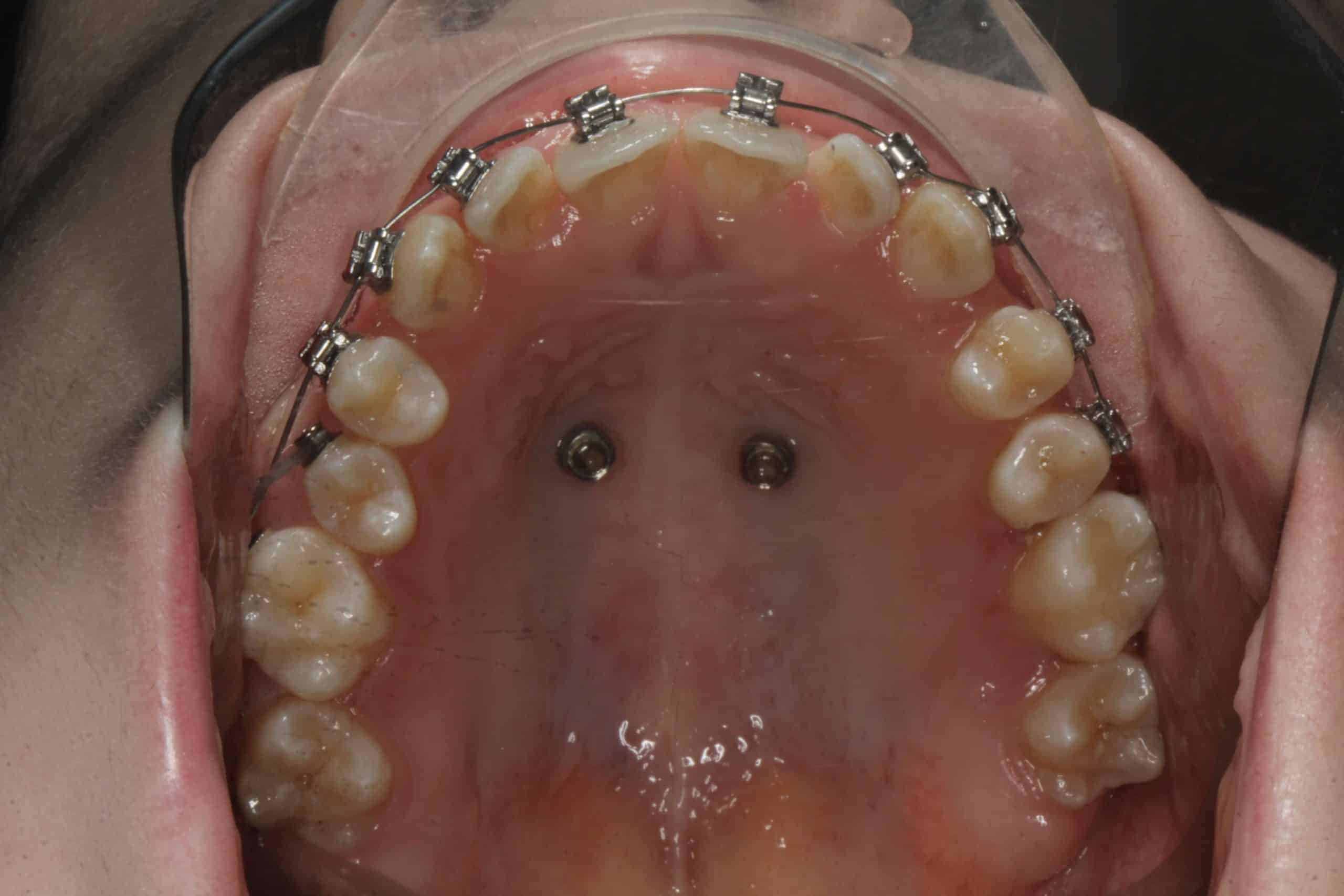 Aftercare for Orthodontic Miniscrews Tips