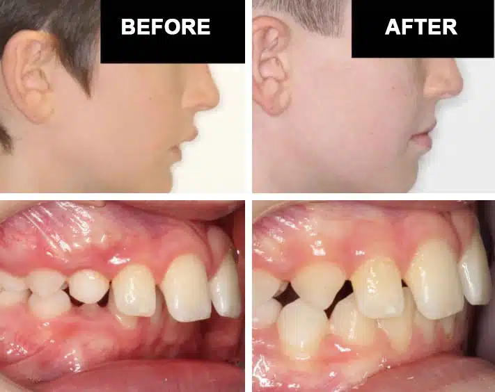 Benefits of Twin Block