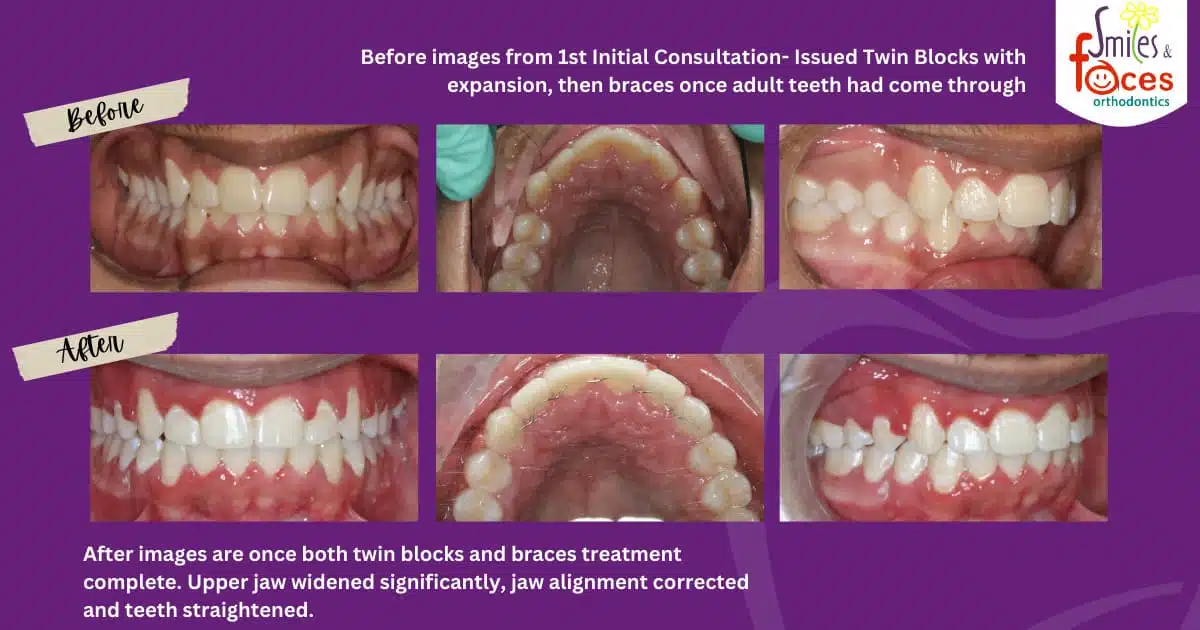 Benefits of Twin Block
