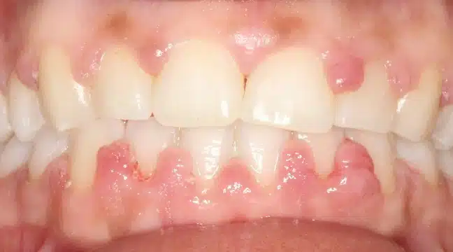 Swollen Gums With Braces?