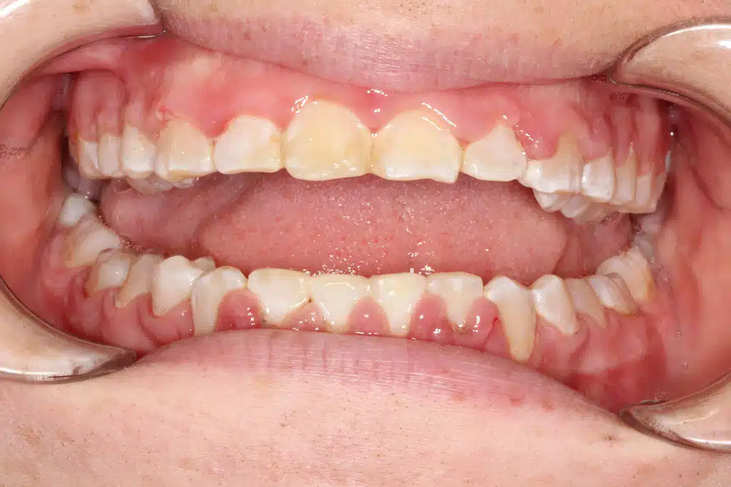 Swollen Gums With Braces?