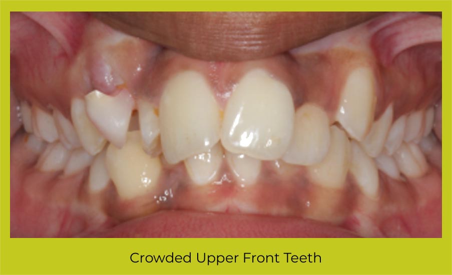 Understanding Narrow Jaw