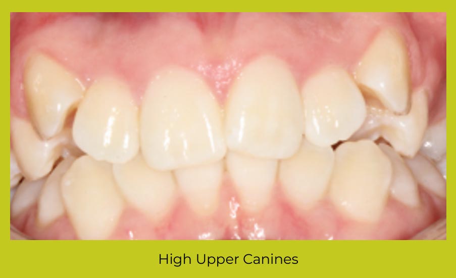 Understanding Narrow Jaw