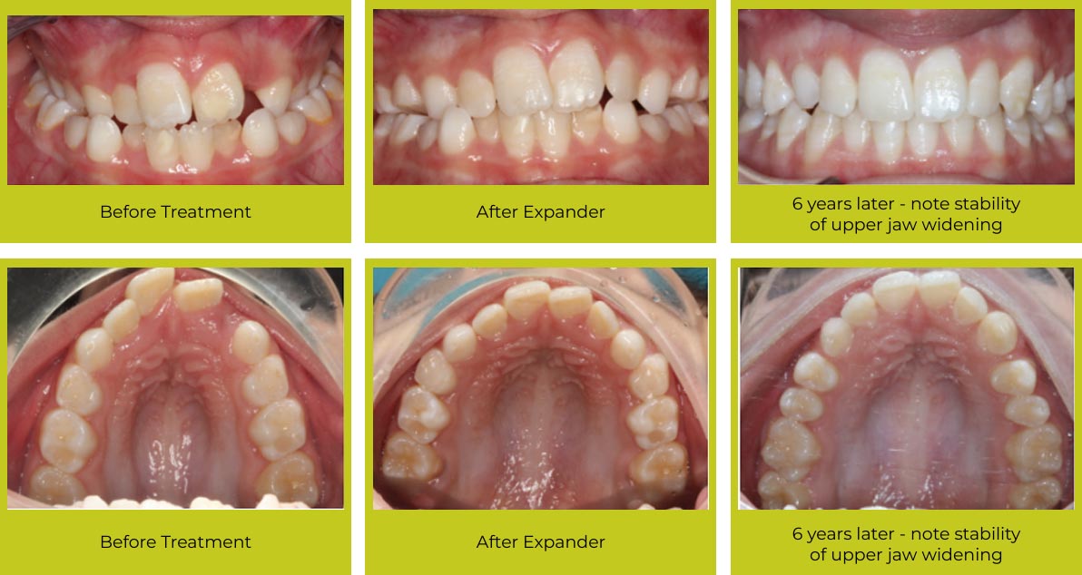 Understanding Narrow Jaw