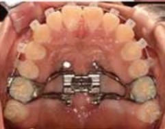 MARPE for Young Adults: A Guide to Jaw Expansion Treatment