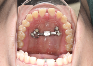 MARPE for Young Adults: A Guide to Jaw Expansion Treatment